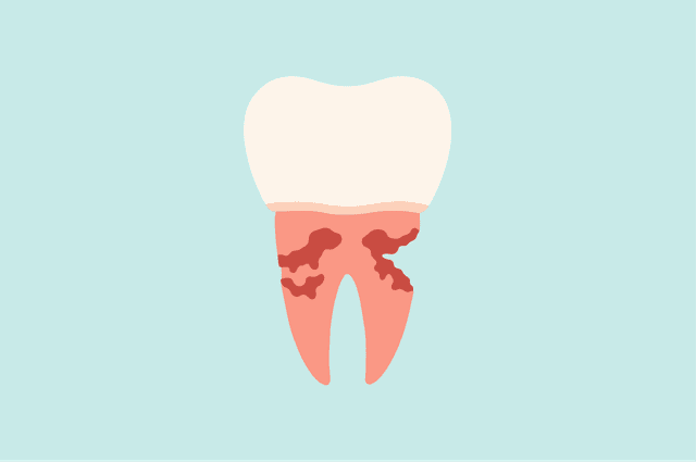 Dead Tooth: Signs, Causes And Pain Management | Yorkshire Dental Suite