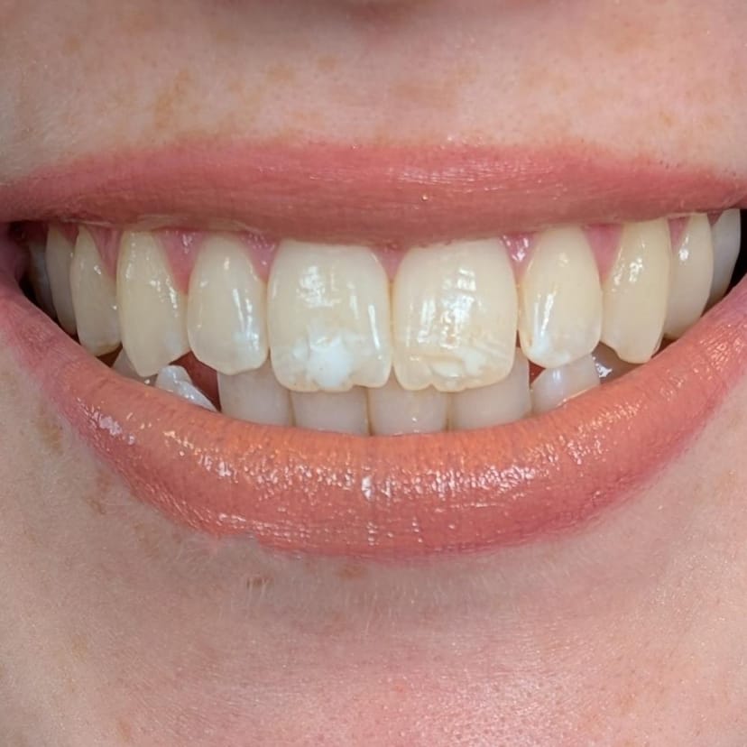 Fluorosis Teeth | Dental Treatment For Fluoride Stains On Teeth ...
