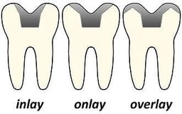 Dental Onlay | What Are Composite Tooth Onlays & Crowns | Yorkshire ...