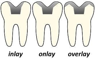 Dental Onlay | What Are Composite Tooth Onlays & Crowns | Yorkshire ...